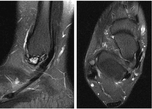 Figure 3 from Unstable Os Subfibulare: Correlation with MR imaging and ...