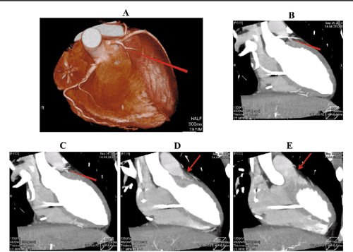 Congenital Ostial Atresia Of The Left Anterior Descending Artery Semantic Scholar congenital-ostial-atresia-of-the-left-anterior-descending-artery-semantic-scholar