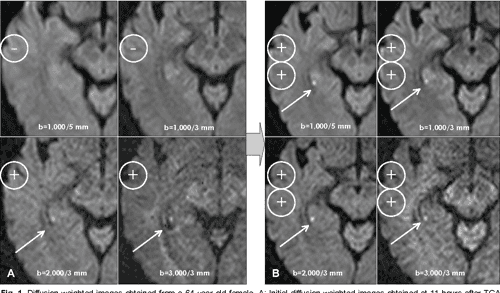 Table 1 from Cerebellar Hypoperfusion during Transient Global Amnesia ...