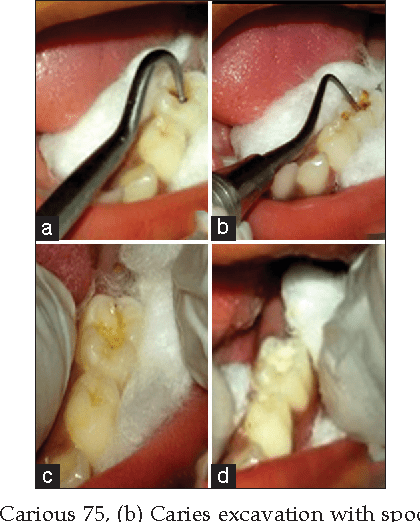 Figure 1 from Chemomechanical caries removal method versus mechanical ...