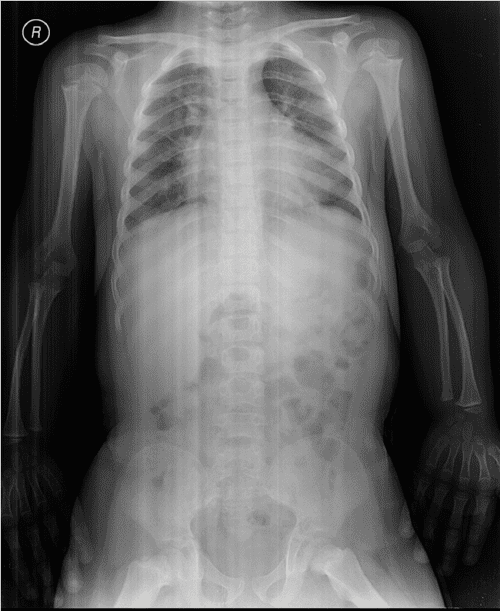 Figure 2 From An Association Of Hypochondroplasia And Immune Deficiency
