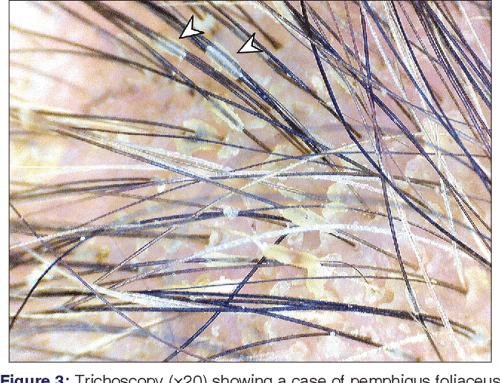 Tubular Hair Casts in Trichoscopy of Hair and Scalp Disorders ...