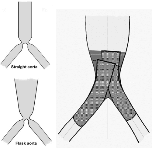 Kissing stent reconstruction of the aortoiliac bifurcation. | Semantic ...
