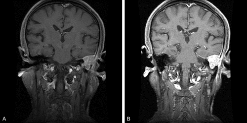 Figure 4 from Squamous cell carcinoma of the middle ear: report of ...