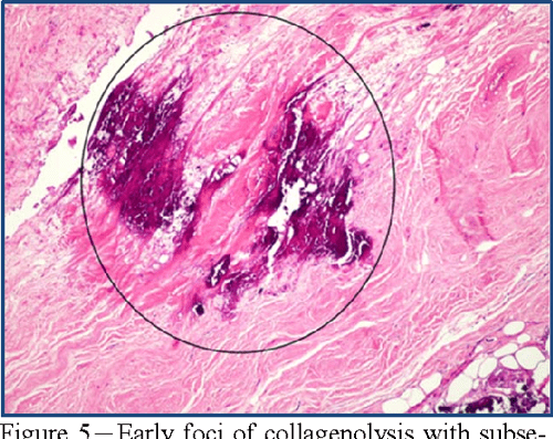 Figure 5 from Calcinosis Cutis , Calcinosis Circumscripta , and “ Mille ...