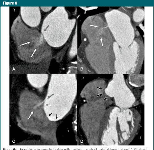 Figure 7 from Imaging of patent foramen ovale with 64-section ...