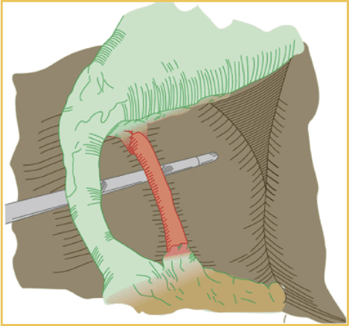 Figure 1 from Technical aspects of cholecystectomy. | Semantic Scholar
