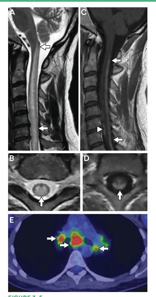 Table 3-1 from Myelitis and Other Autoimmune Myelopathies | Semantic ...