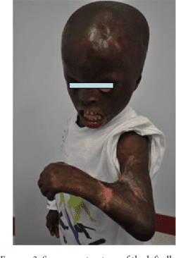 Figure 1 from Clinical Variant of Ablepharon Macrostomia Syndrome ...