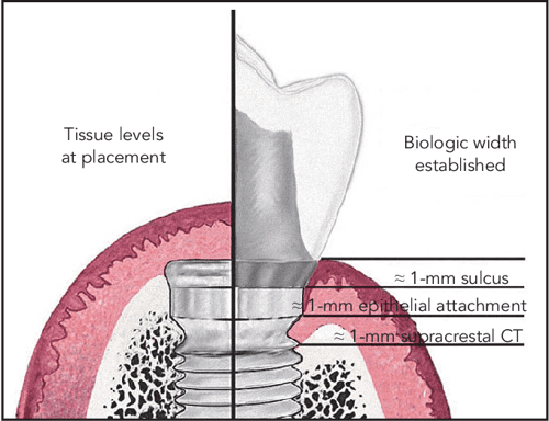 [PDF] Platform switching: a new concept in implant dentistry for ...