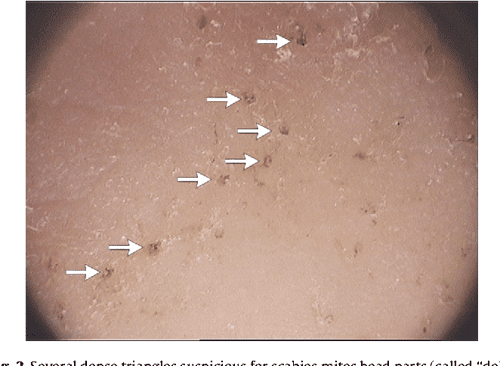Figure 2 from Crusted (Norvegian) scabies | Semantic Scholar