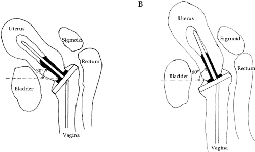 Figure 2 from Computed tomography-based treatment planning for high ...