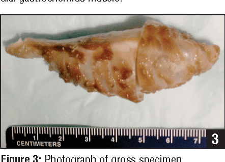 Intramuscular dissection of a large ganglion cyst into the ...