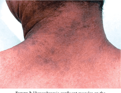 [PDF] Lichen planus pigmentosus inversus* | Semantic Scholar