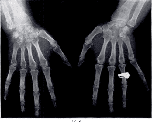 Figure 11 from Sudeck's atrophy in the hand. | Semantic Scholar