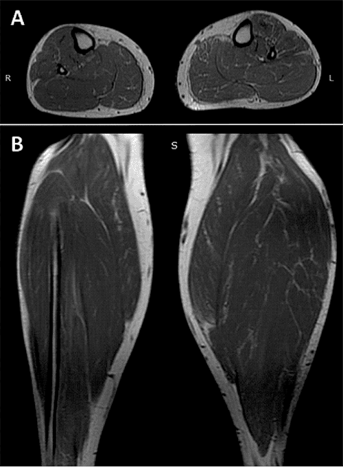 Figure 2 from Neurogenic muscle hypertrophy as an uncommon case of the ...