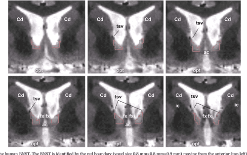 Manual segmentation of the human bed nucleus of the stria terminalis ...