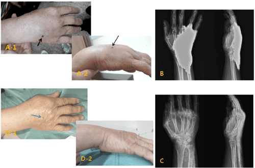 Management of Subcutaneous Extravasation of Contrast Media during ...
