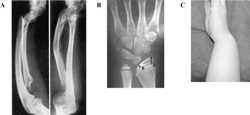 Figure 1 from Acute lymphoblastic leukemia in a child with Leri-Weill ...