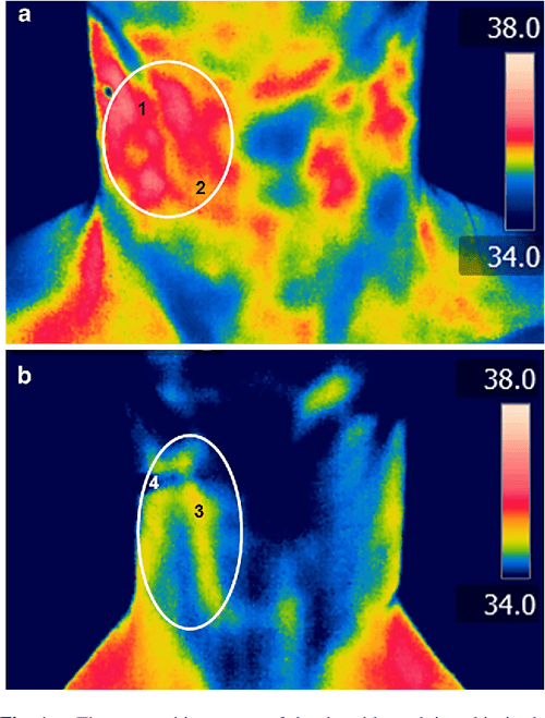 Neck thermography in the differentiation between diffuse toxic goiter ...