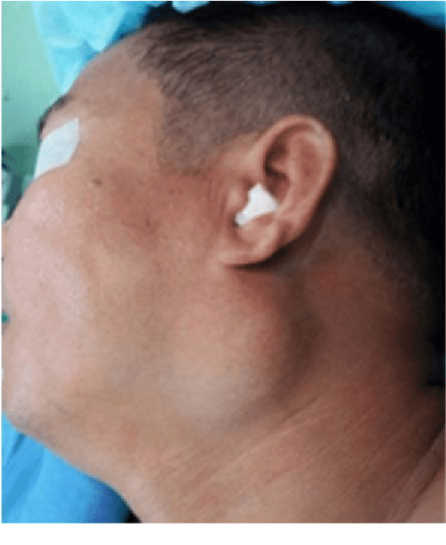 Table 1 from Benign Lymphoepithelial Cyst of Parotid Glands in HIV ...