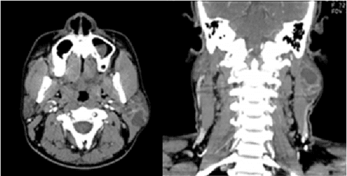 Figure 1 from Benign Lymphoepithelial Cyst of Parotid Glands in HIV ...