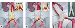 [PDF] Covered endovascular reconstruction of aortic bifurcation (CERAB ...