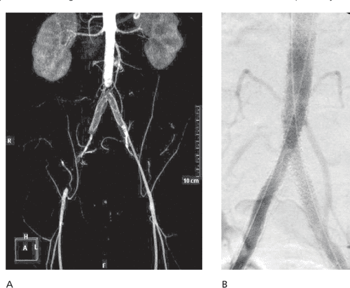 Figure 3 from Covered endovascular reconstruction of aortic bifurcation ...