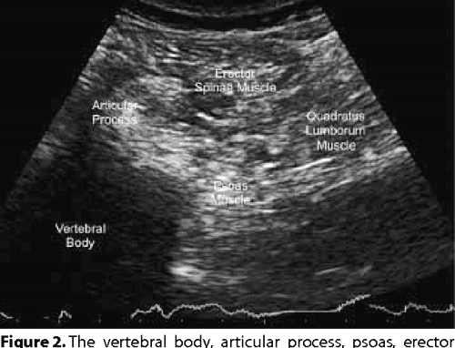 Figure 1 from Ultrasound-guided psoas compartment block and general ...