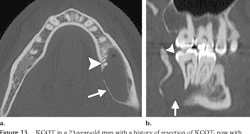 Periapical lucency around the tooth: radiologic evaluation and ...
