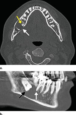 Periapical lucency around the tooth: radiologic evaluation and ...