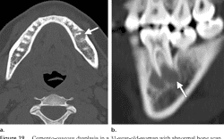 Periapical lucency around the tooth: radiologic evaluation and ...