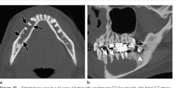 Periapical lucency around the tooth: radiologic evaluation and ...