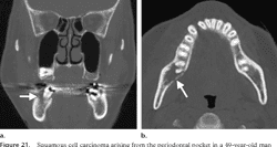 Periapical lucency around the tooth: radiologic evaluation and ...