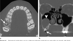Periapical lucency around the tooth: radiologic evaluation and ...