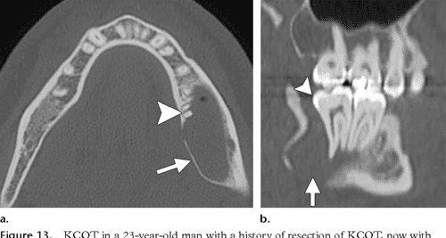 Periapical lucency around the tooth: radiologic evaluation and ...