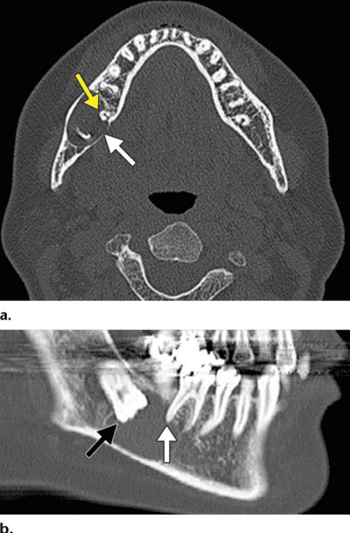 Periapical lucency around the tooth: radiologic evaluation and ...