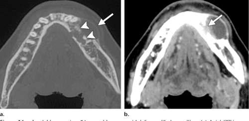 Periapical lucency around the tooth: radiologic evaluation and ...