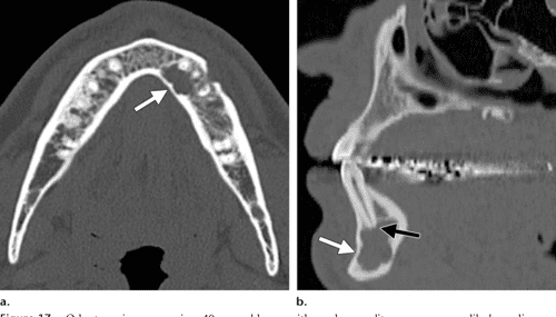 Periapical lucency around the tooth: radiologic evaluation and ...