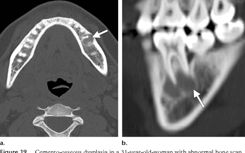 Periapical lucency around the tooth: radiologic evaluation and ...