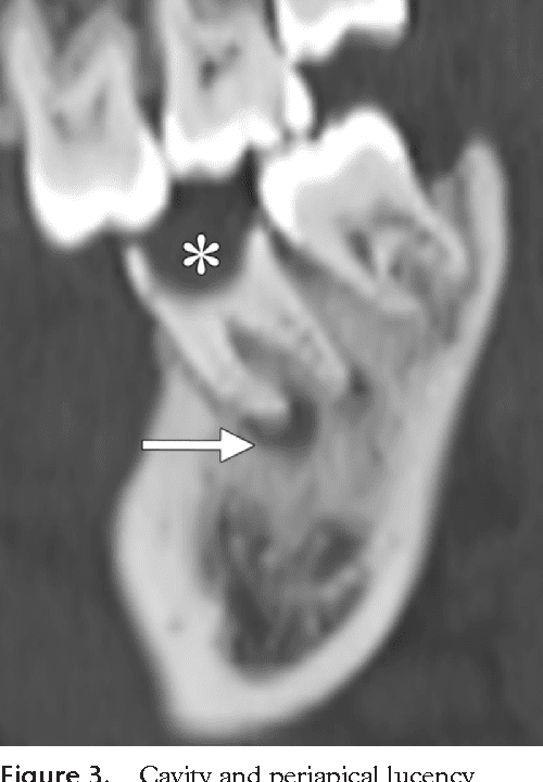 Periapical lucency around the tooth: radiologic evaluation and ...