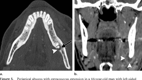 Periapical lucency around the tooth: radiologic evaluation and ...