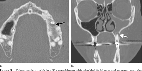 Periapical lucency around the tooth: radiologic evaluation and ...