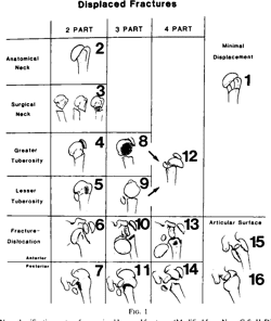 Figure 1 from The Neer Classification System for Proximal Humeral ...
