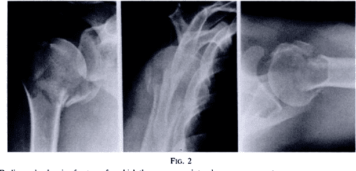 Figure 1 from The Neer Classification System for Proximal Humeral ...