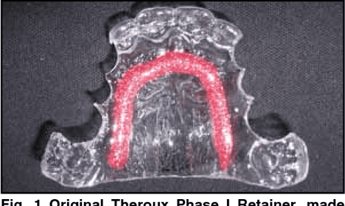 Figure 3 from A modified Theroux Phase I retainer design. | Semantic ...