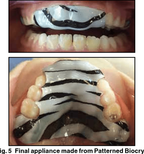 Figure 3 from A modified Theroux Phase I retainer design. | Semantic ...