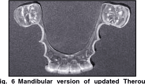 Figure 3 from A modified Theroux Phase I retainer design. | Semantic ...