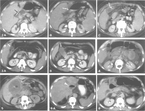 CT appearance of the Roux limb following choledochojejunostomy in liver ...