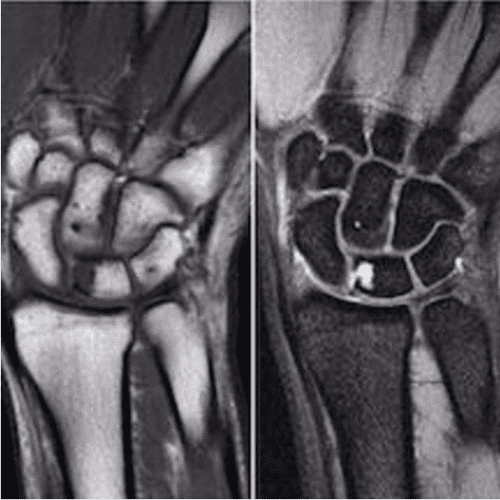 Figure 2 From Intraosseous Ganglion Cyst Of The Lunate The Pseudo Kienbock Lesion Semantic